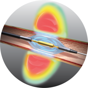 Paradise Ultrasound RDN System - Recor Medical