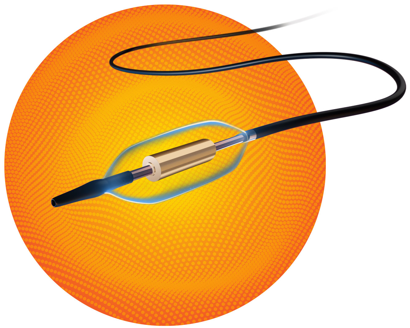 Paradise Ultrasound RDN System - Recor Medical