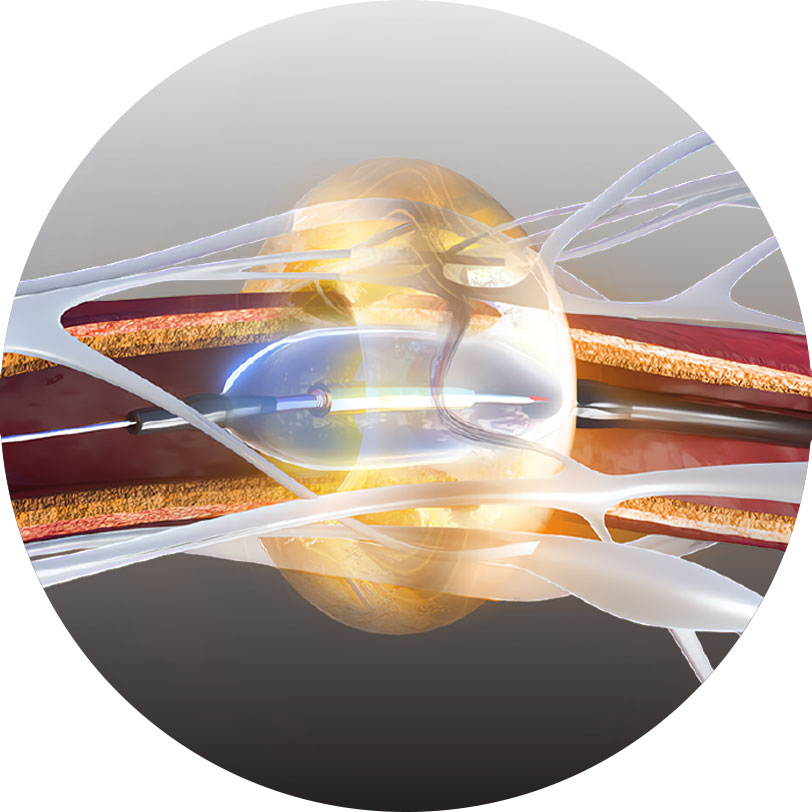 Paradise Ultrasound RDN System - Recor Medical